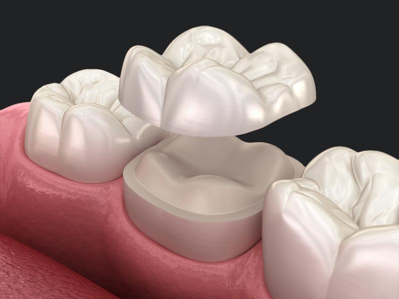 INCRUSTACIONES DENTALES | CLÍNICA RANALLI