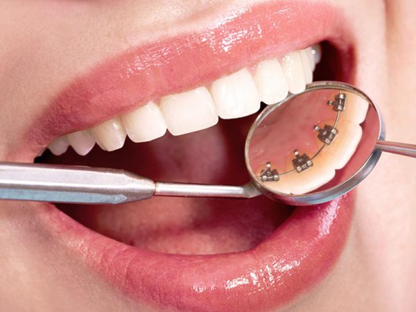 BRACKETS LINGUALES | CLÍNICA RANALLI