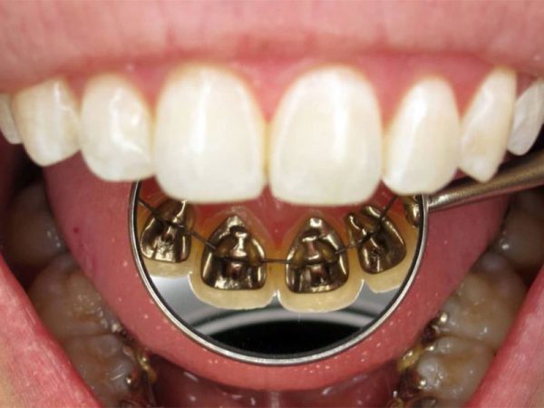 BRACKETS LINGUALES | CLÍNICA RANALLI